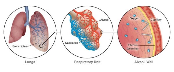 What is Interstitial Lung Disease? - NOVA Pulmonary